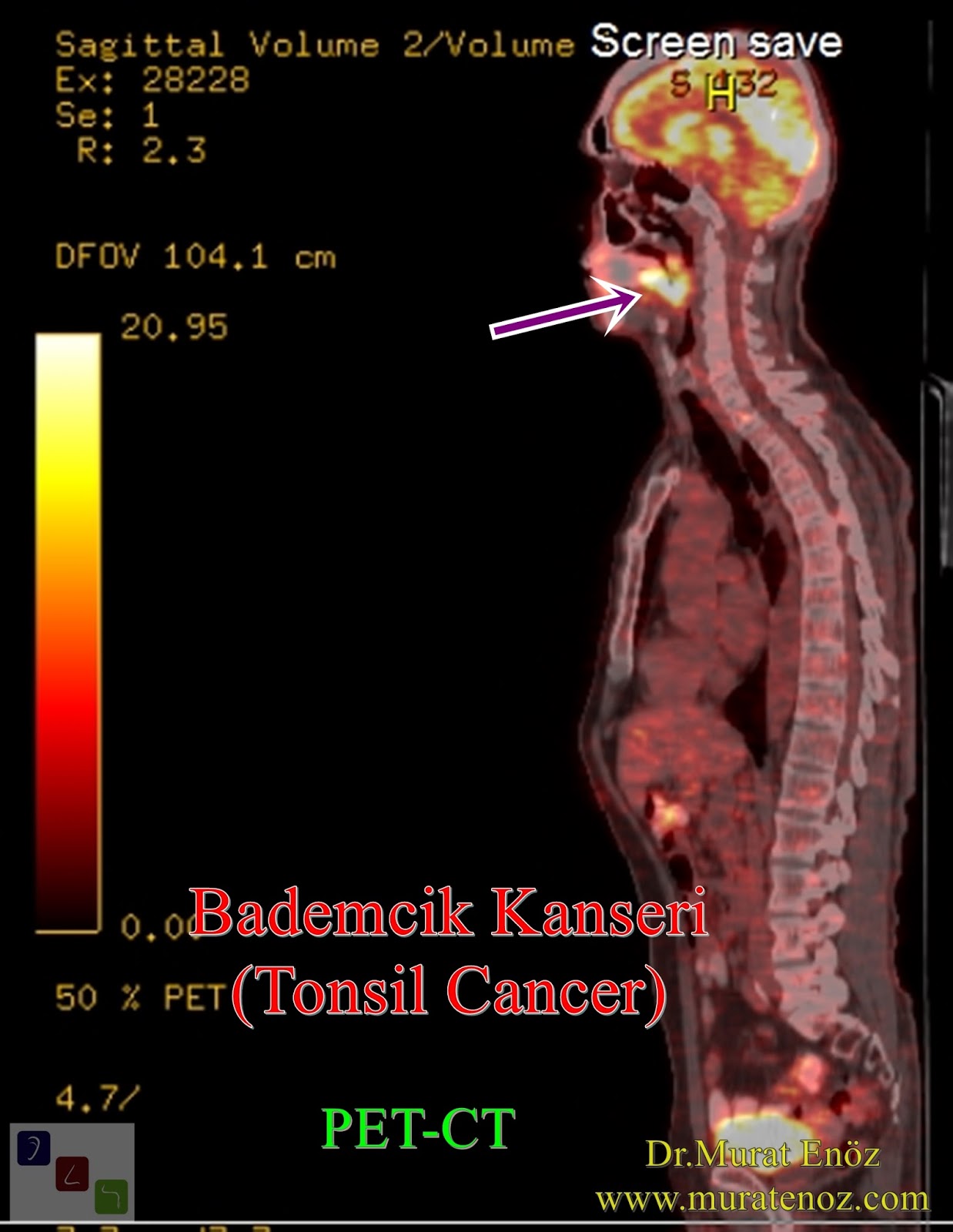 Tonsil Cancer - Causes, Symptoms, Diagnosis and Treatment