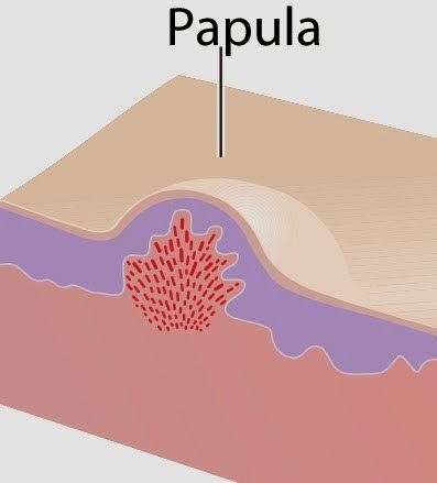 Papula