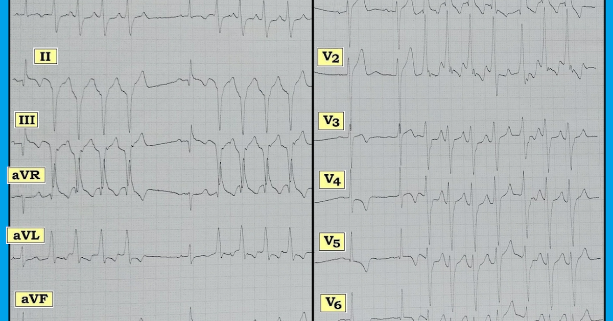 ECG Interpretation: ECG Blog #151 — Is Ashman Overused?