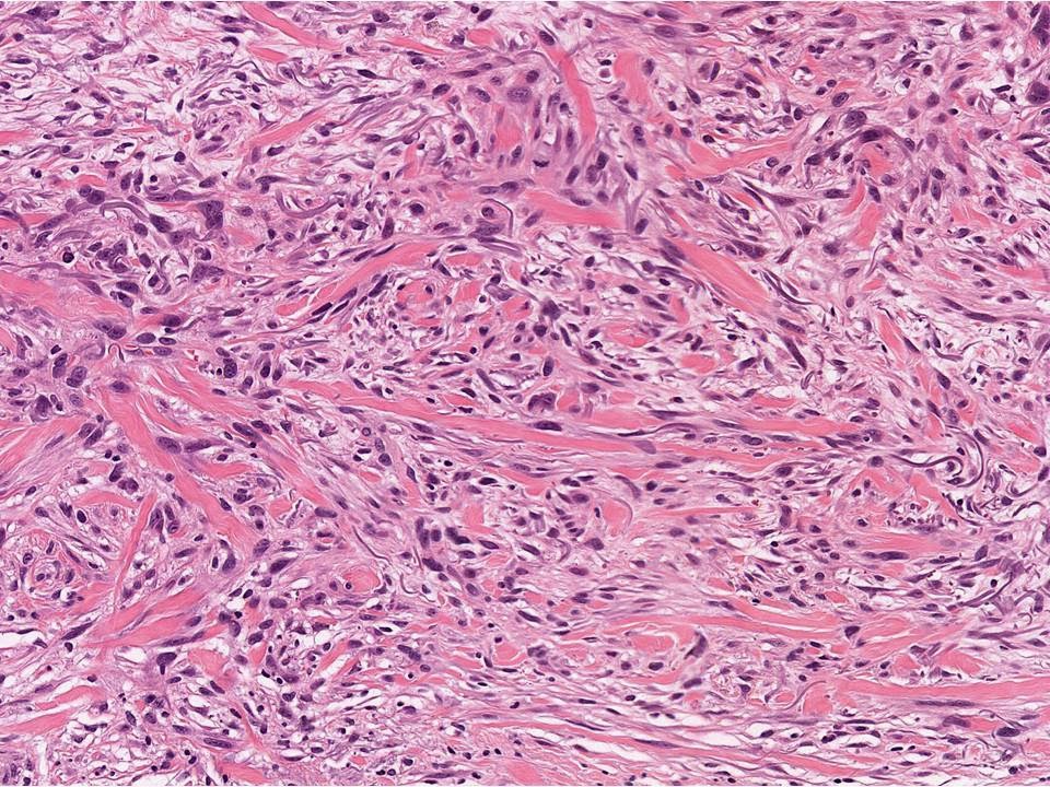 Dermpath Made Simple - Neoplastic: Atypical Fibroxanthoma
