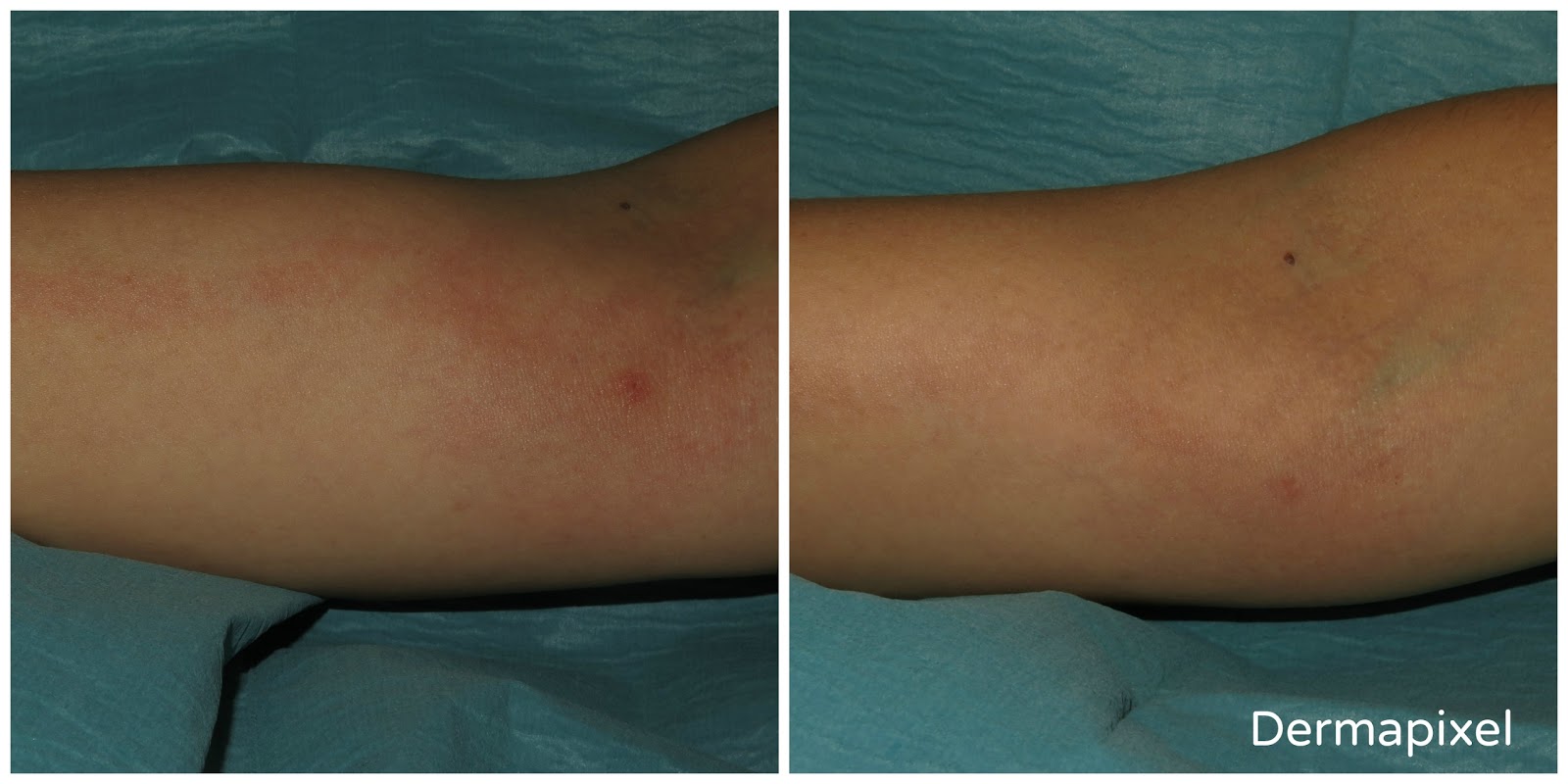 Dermapixel: julio 2017