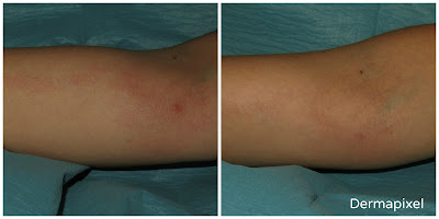 Dermapixel: julio 2017