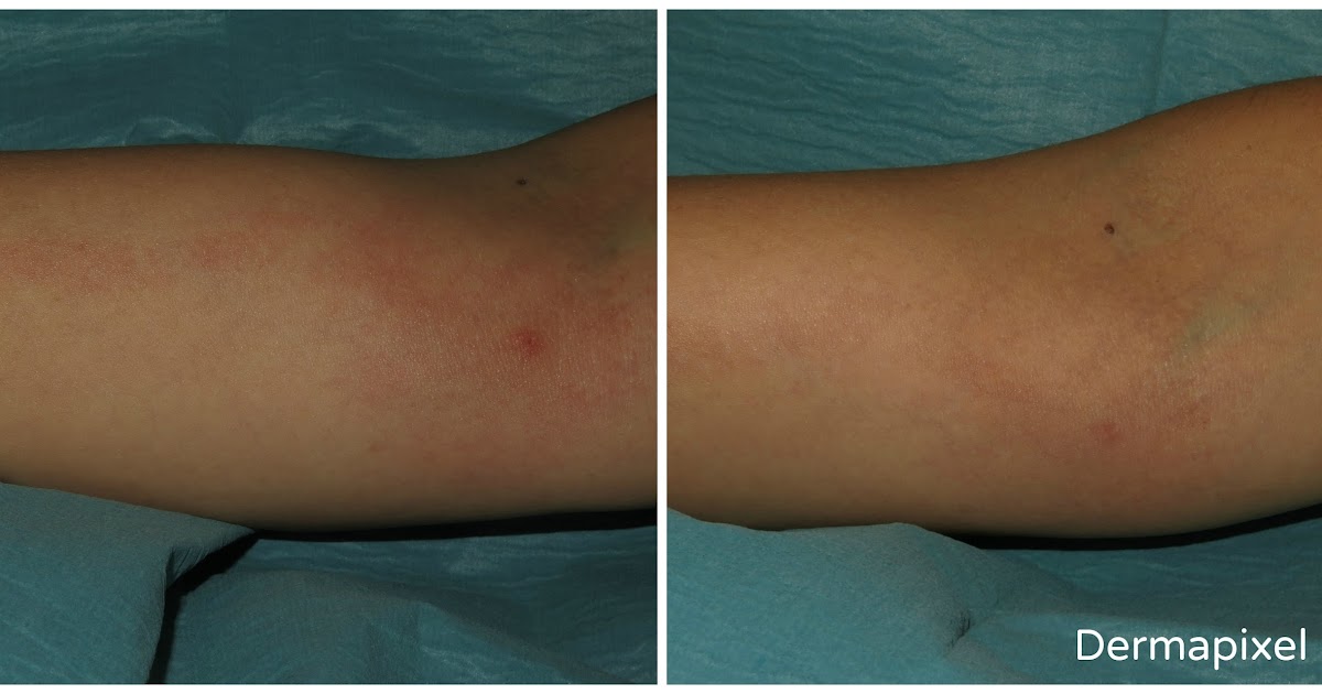 Dermapixel: Linfangitis aguda: Cuando las bacterias se van de paseo por ...