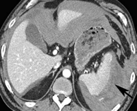 Abdominal Section: Peritoneal and omental sign 1:Sentinel clot sign