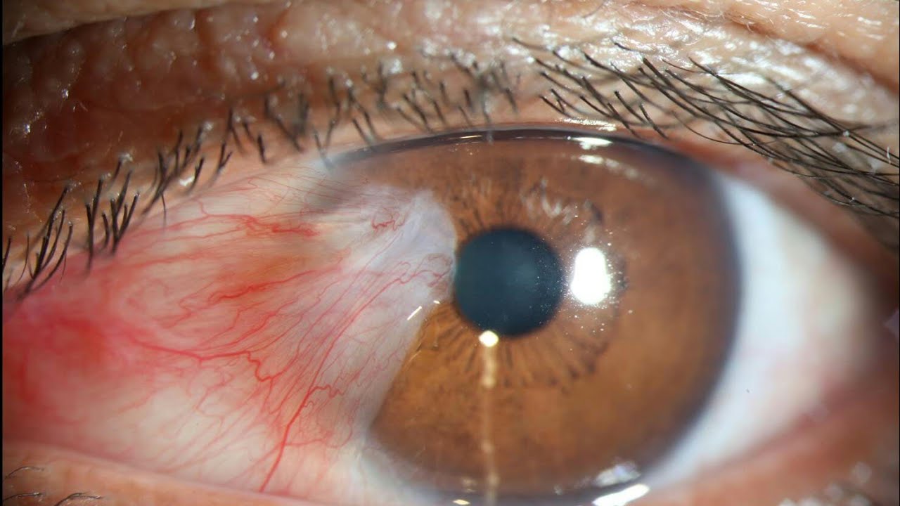 Aprende a eliminar la carnosidad de los ojos de manera natural ~ Solo Salud