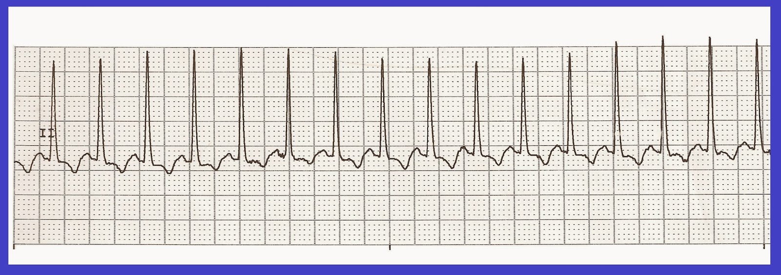 EKG Rhythm Strip Quiz 214