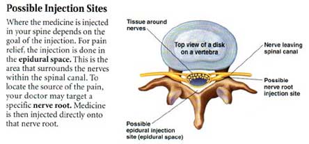 Procedures Book for Spine and Joint Pain: Injection Book