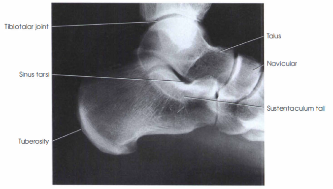 LATERAL-MEDIOLATERAL PROJECTION : LOWER LIMB-CALCANEUS - RadTechOnDuty