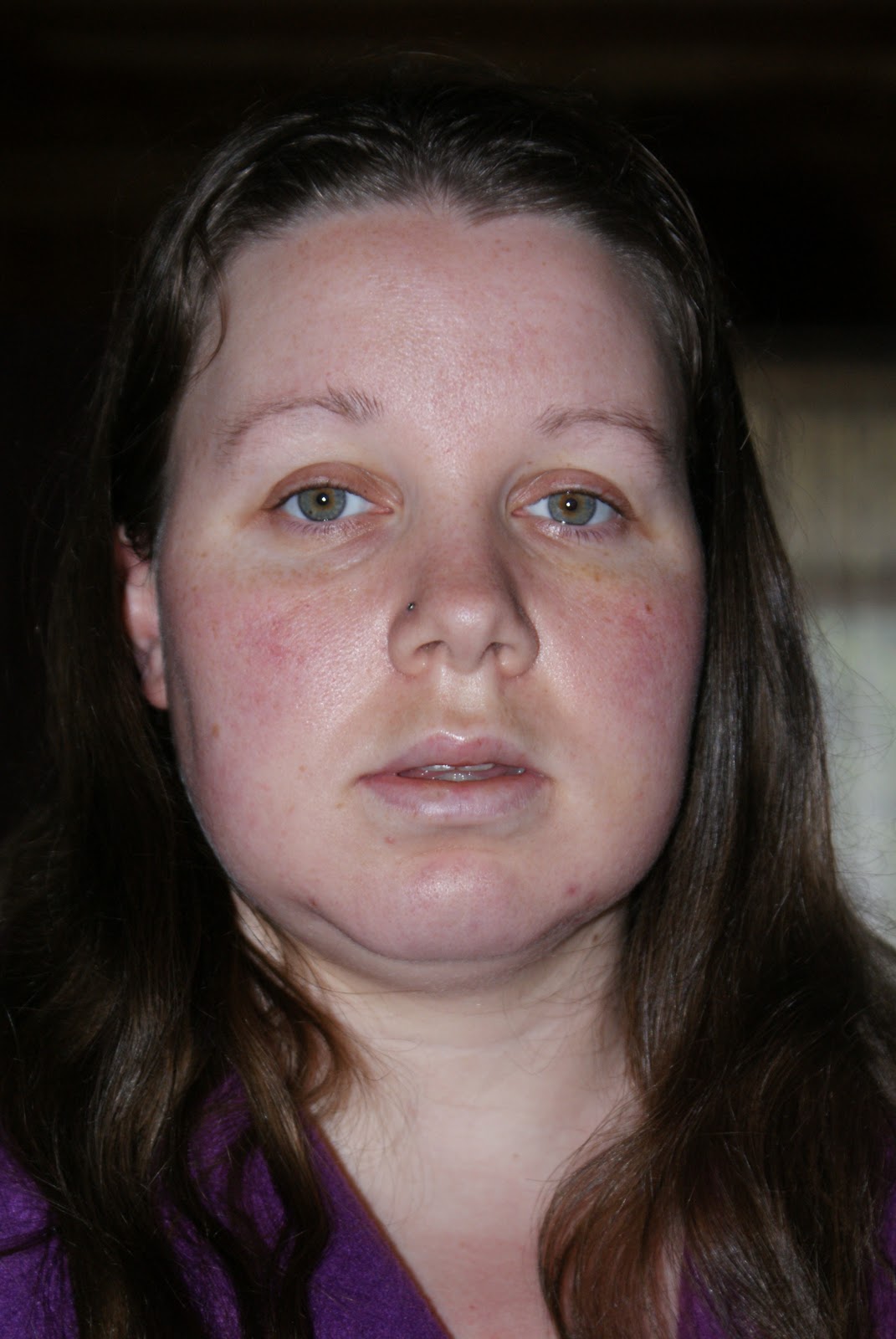 Braces + SARPE/SARME Surgery