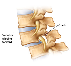 Exercise and Spondylolisthesis