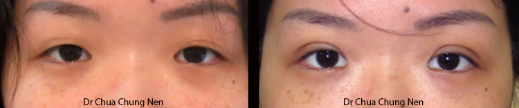 Eyelid Surgery by Prof Dr CN CHUA 蔡鐘能: Doc, Can You Show Me Pictures of ...