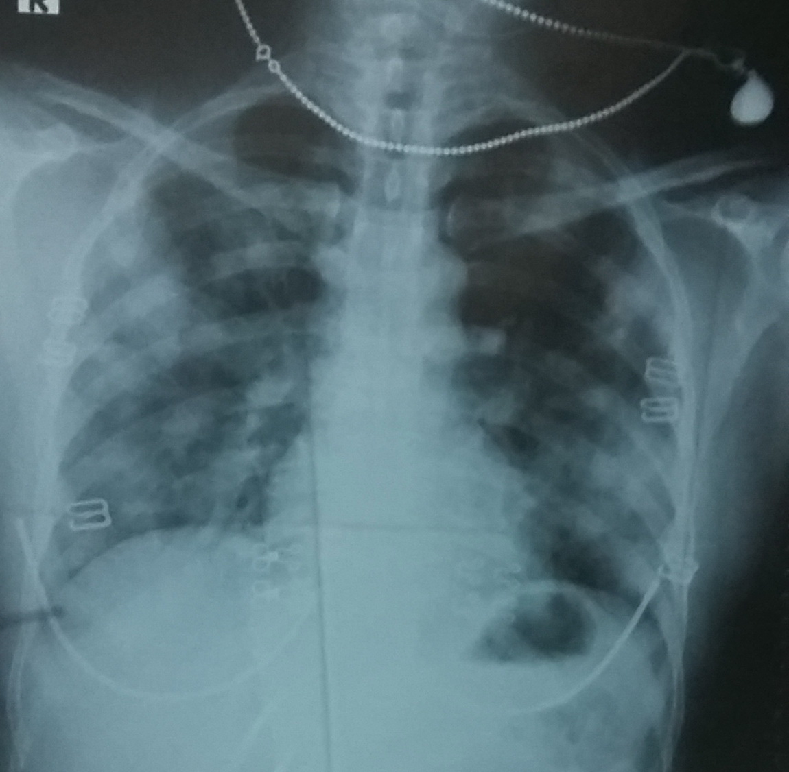 VIETNAMESE MEDIC ULTRASOUND: CASE 465: LUNG with LOFFLER SYNDROME, Dr ...