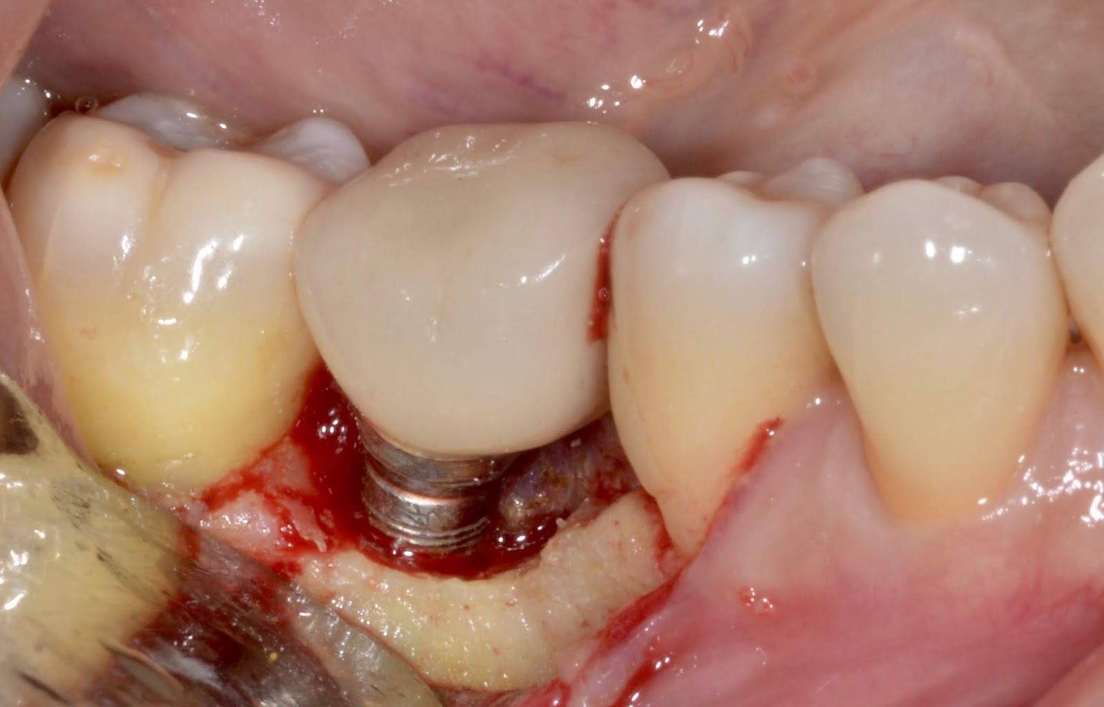 Carl Conley: CT graft to help the Peri-Implant Infection site