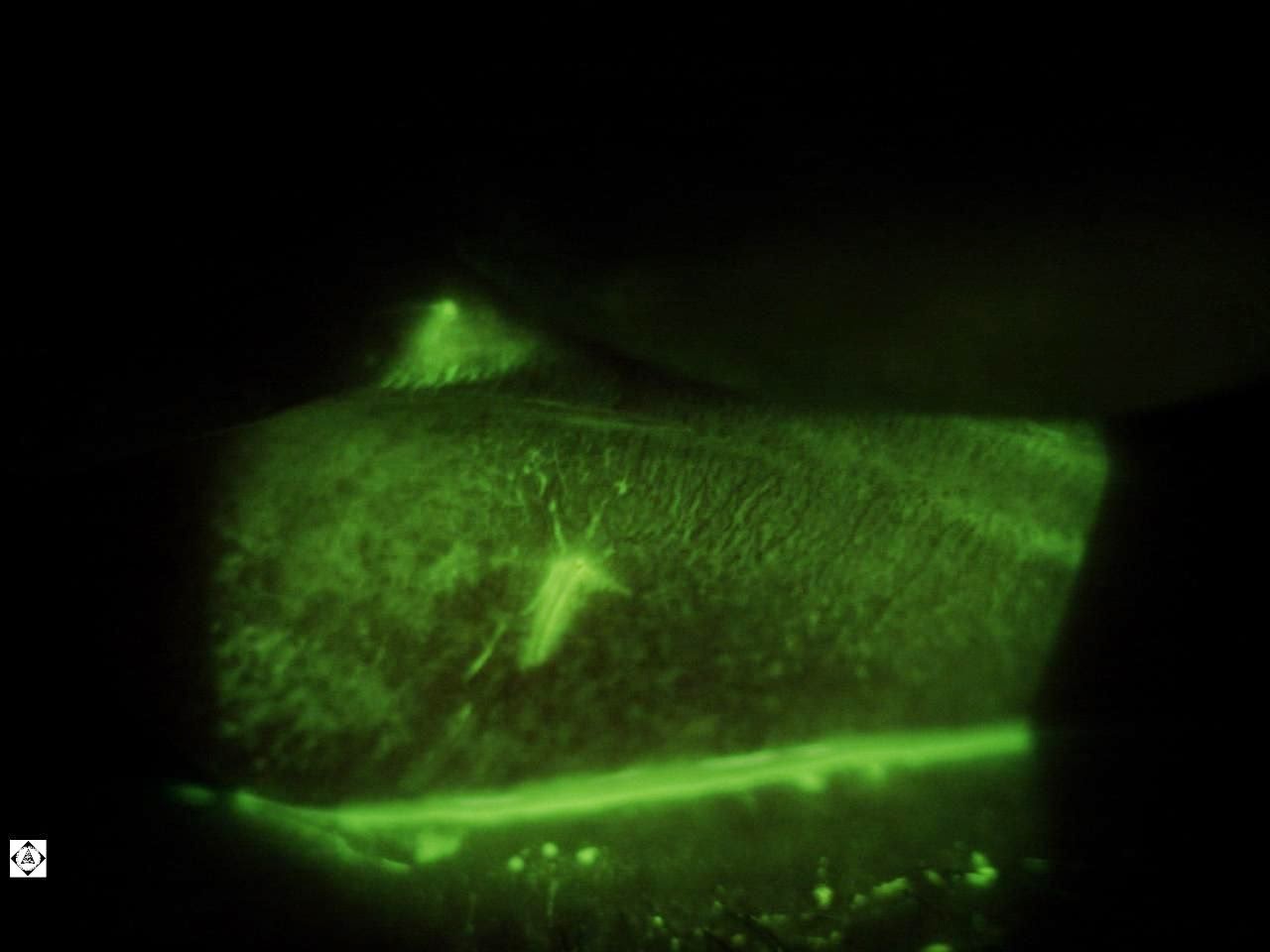 Sonoran Desert Eye Center: PALPEBRAL CONJUNCTIVAL FOREIGN BODY