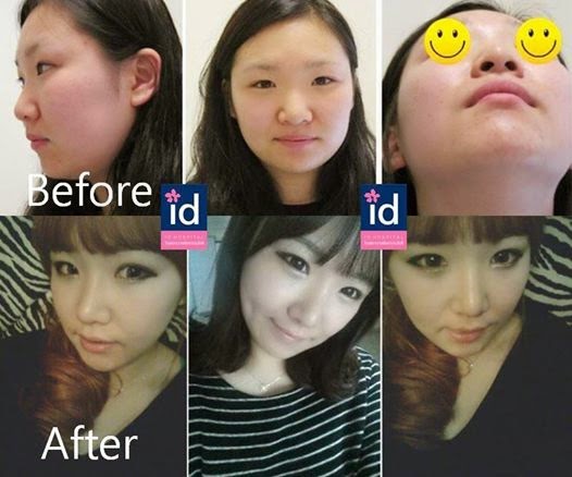 ID Hospital Korea: The Amazing Plastic Surgery Makeover Transformation ...