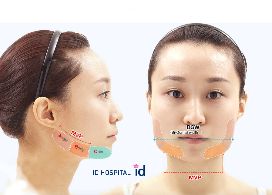 ID Hospital Korea: Jaw line affects impression.. MVP square jaw ...