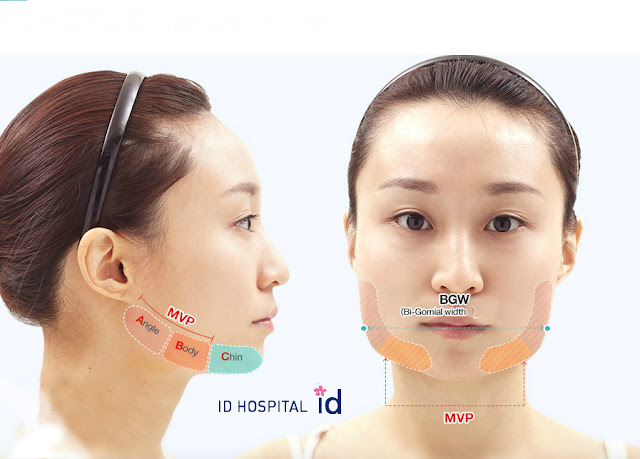 ID Hospital Korea: Jaw line affects impression.. MVP square jaw ...