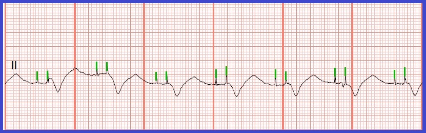 Practice EKG Rhythm Strips 143: Various Hyperkalemia