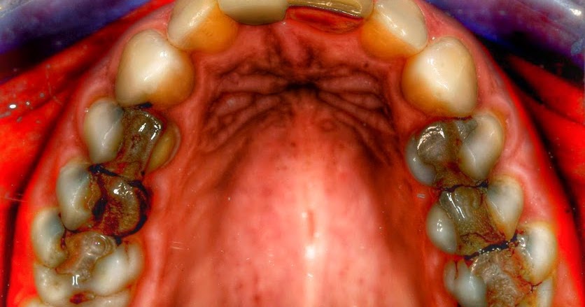 AMÁLGAMA: Composição - Videoconferência do Prof. Gustavo Rivera - Odonto-Tv