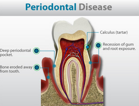 Lisa Wentz Lubbock Periodontics: Signs & Symptoms of Periodontal Disease