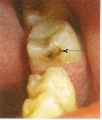 Dentistry and Medicine: Dental Caries definition, Classification of ...