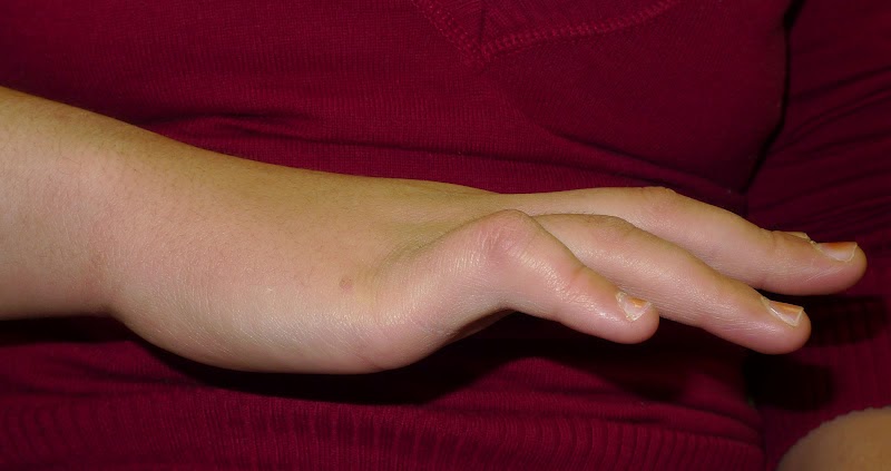 Camptodactyly | Congenital Hand and Arm Differences