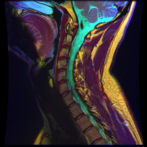 Nevit's blog: Color MRI of Cervical vertebrae