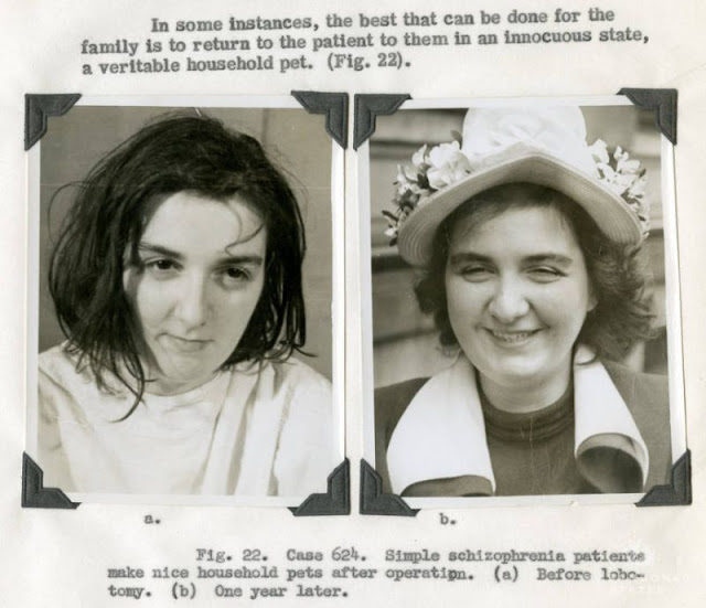 Do You Need a Lobotomy? Just Look at the Results From These Before and ...