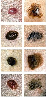 How To Identify Cancerous Skin Moles | Mole Removal Tips and Techniques