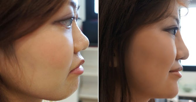 Chin Fillers Singapore Price and Reviews 2022 (Non-surgical Chin Jobs)