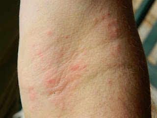 Lise's Log Cabin Life: Jewelweed & Poison Ivy