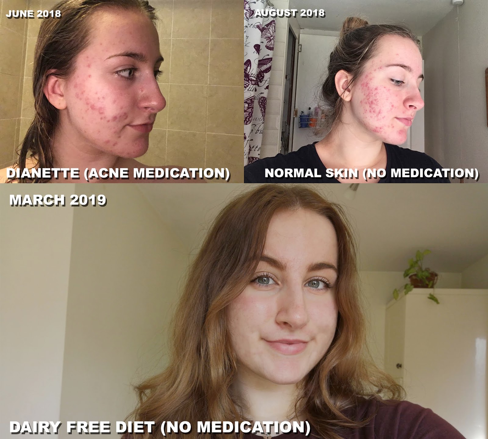 How I went from a face full of acne to near perfect skin in just 5 ...