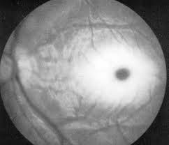 Medical Treatment Pictures-for Better Understanding: Sandhoff Disease