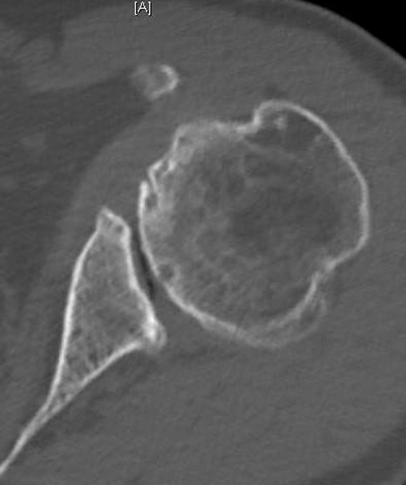 UW Shoulder and Elbow Academy: Shoulder joint replacement arthroplasty ...