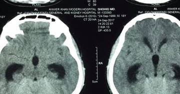 What is the most appropriate interpretation of this CT Scan ...
