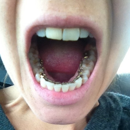 B's Beauty Blog: Incognito braces - train tracks for adults!