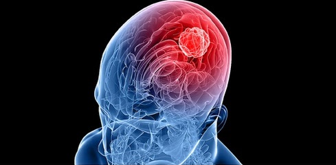 Grande avanço no entendimento genético do câncer cerebral ...