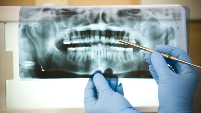 Hagen Dental Do I Need A Root Canal hagen-dental-do-i-need-a-root-canal