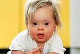 SINDROME DE DOWN: sindrome de down