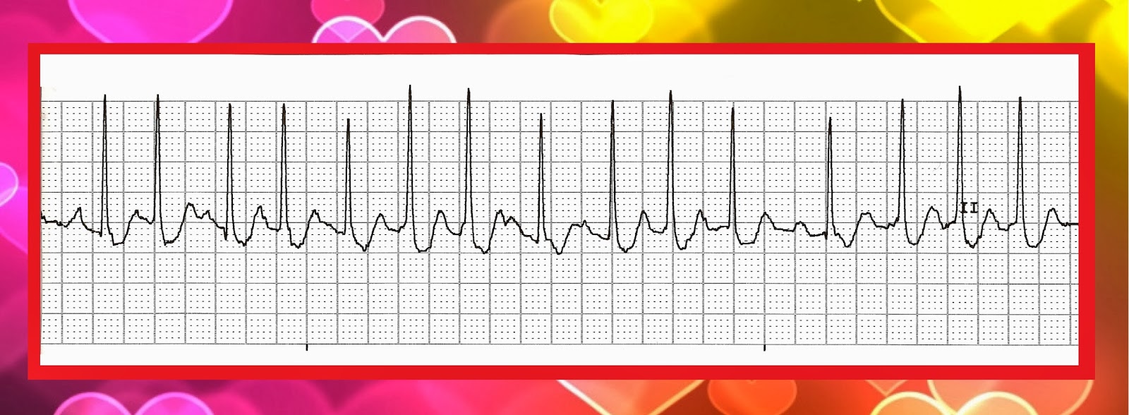 Practice Rhythm Strips 239