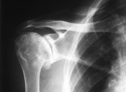 O R T O C R I T I C A: Artrosis Glenohumeral Terminal
