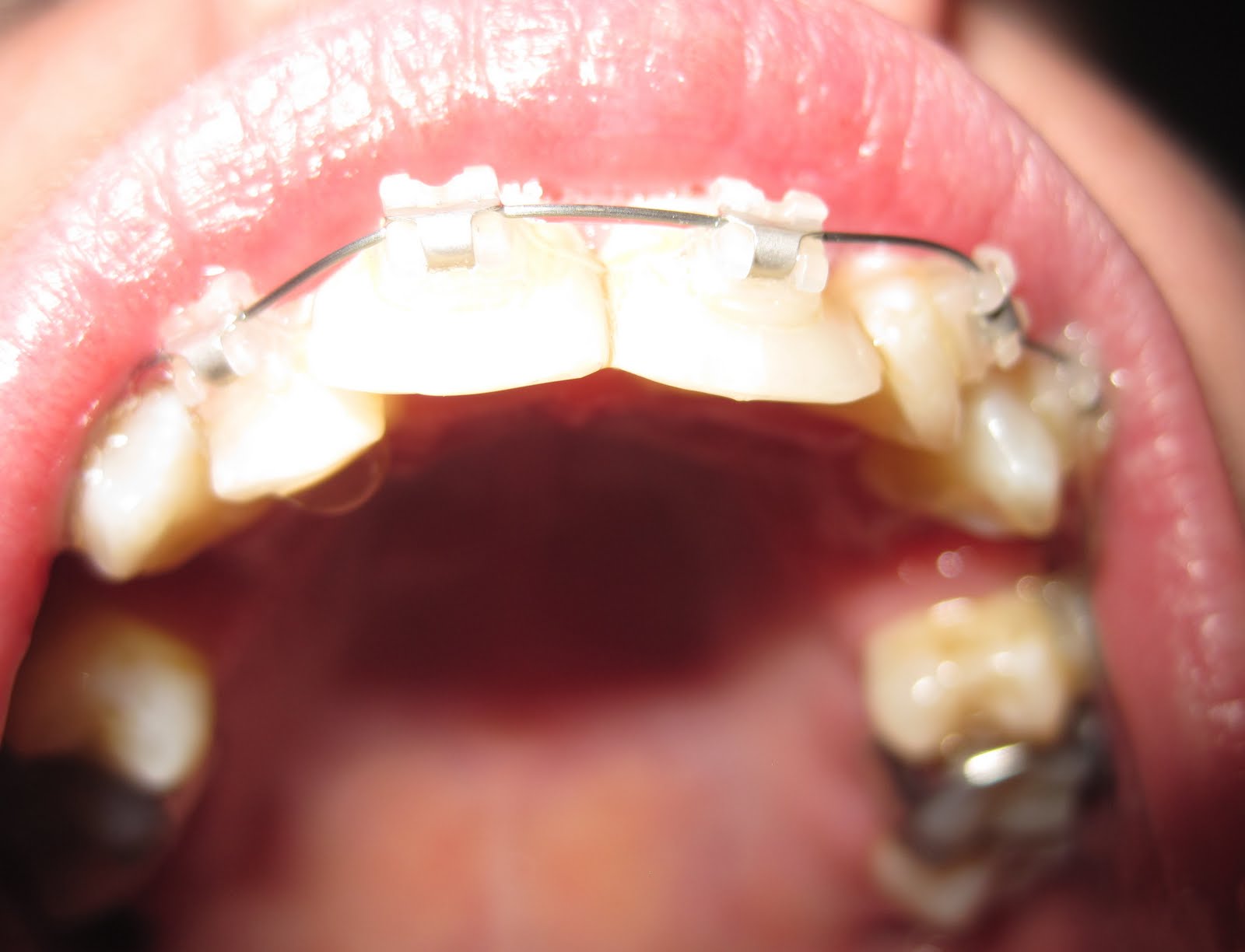 A 29 year old's braces diary...: Random observations 2 weeks in...