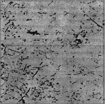 Angina Plaut Vincent