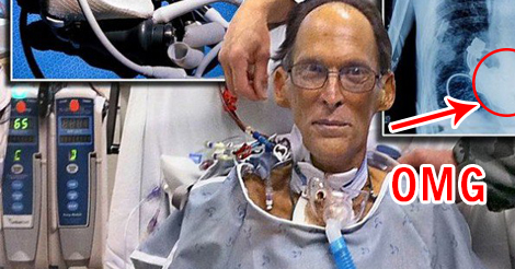 Craig Lewis The World’s First Heartless Human Able To Live Without A ...