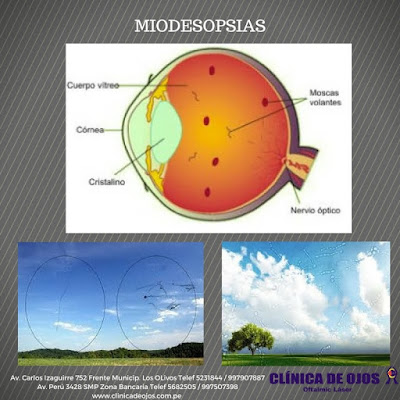 Clínica de Ojos Oftalmic Láser: MIODESOPSIAS