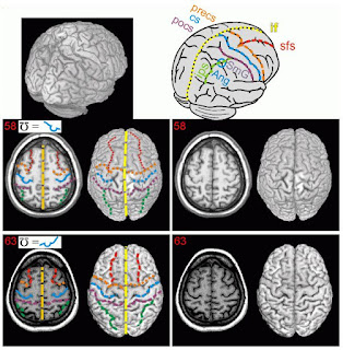 la neuroimagen: Identificar el surco central
