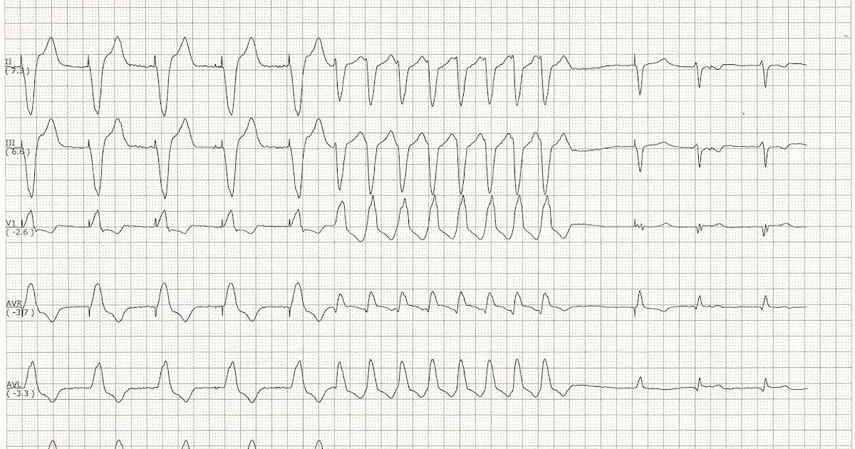 Ventricular paced with a run of VT