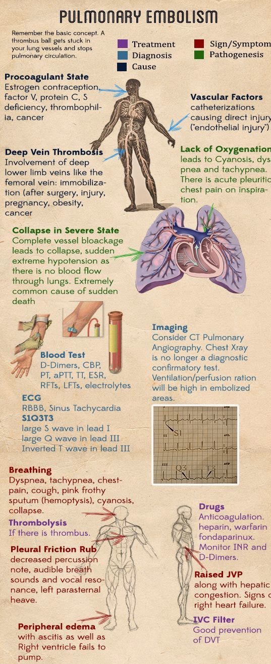 Chest Medicine Made Easy-Dr Deepu: Pulmonary Embolism!!!! Picture Card