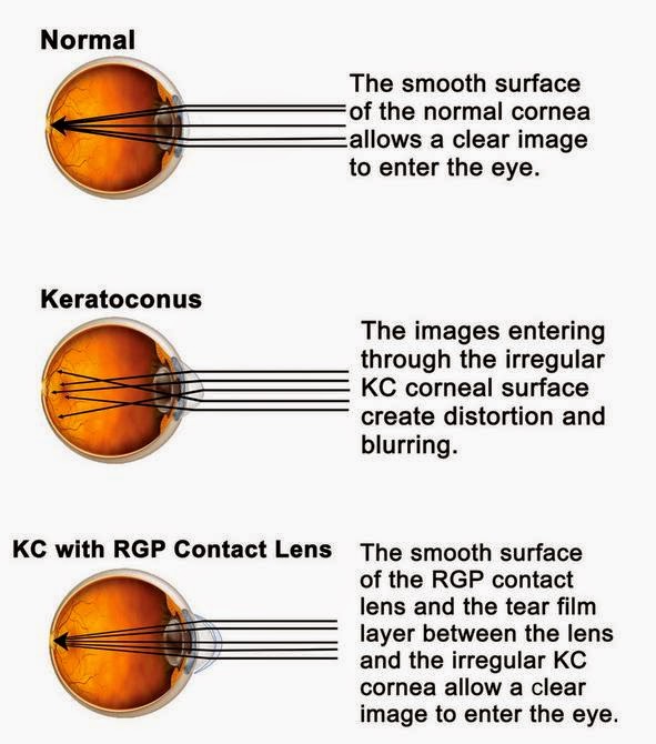 eyecing on the cake: Keratoconus