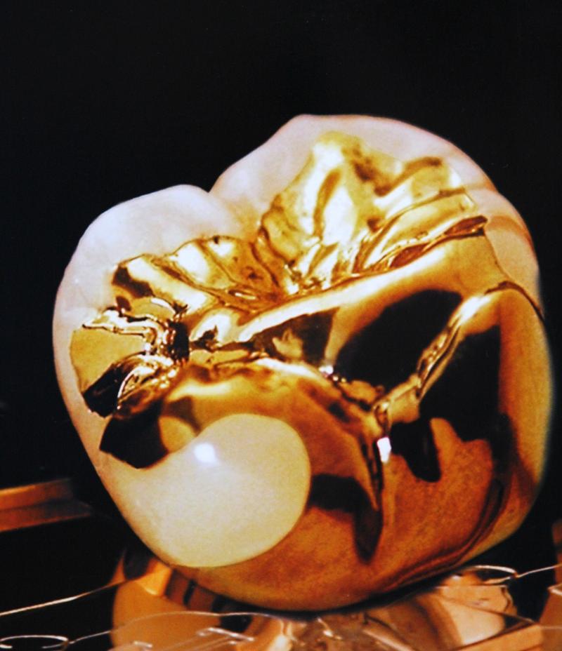 Get your smile on!: Gold Dental Inlays